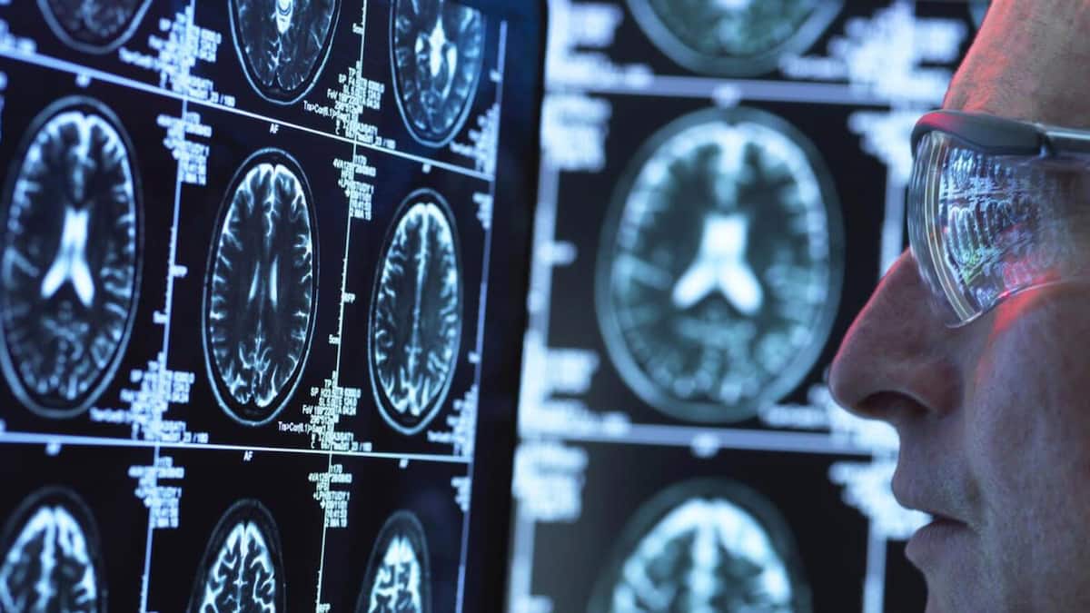 Alzheimer-Medikament von Biogen zugelassen | Handelszeitung